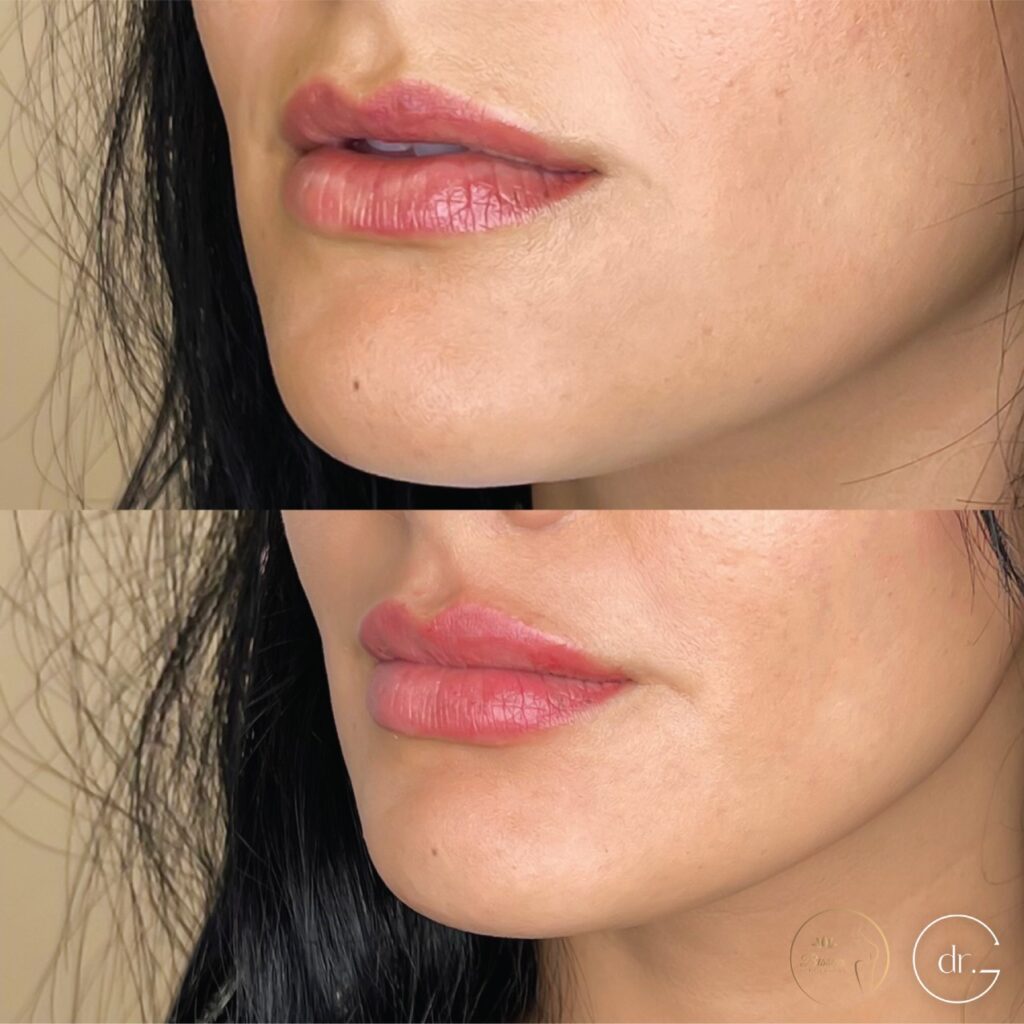Lip Fillers Dubai | Enhance Your Smile with Expert Care